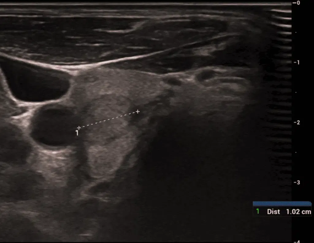TIRADS TM For Managing Thyroid Nodules on Ultrasound | IAME