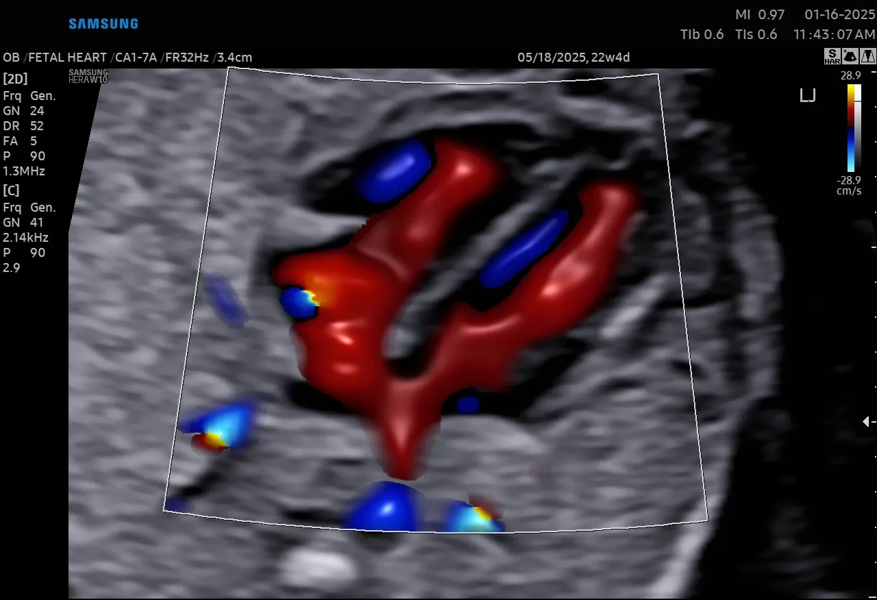 Part 1 Fetal Cardiac Morphology: Understanding the Four Chambers and ...