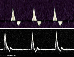 Arterial and Venous Doppler Waveform Nomenclature - Arterial and Venous ...