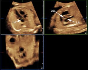 Courses | Volumetric Imaging of the Fetal Heart | Institute for ...