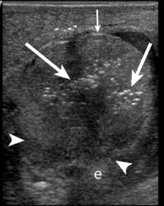 Ultrasound Evaluation of Acute Scrotal Pain - Final Quiz | IAME