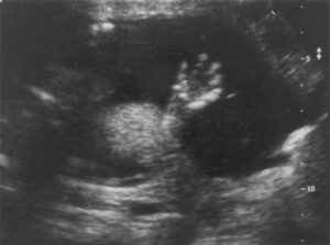 The Biophysical Profile Score | IAME