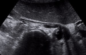 Renal Doppler Case Series