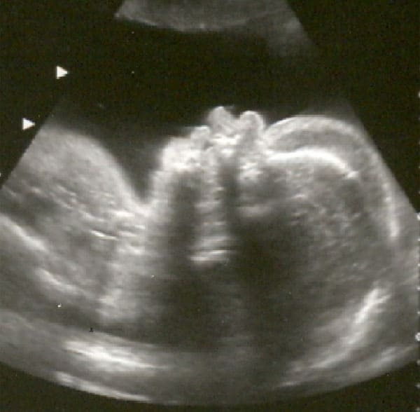 Non-Immune Hydrops | IAME