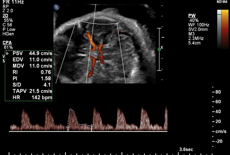 Multi-Vessel Doppler Studies in Intra-Uterine Growth Restriction | IAME