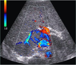 Liver Doppler Case Series | IAME