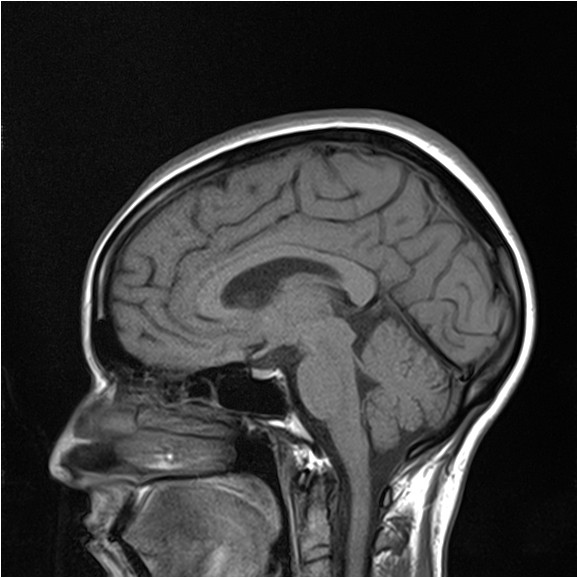 Dandy Walker Complex | IAME