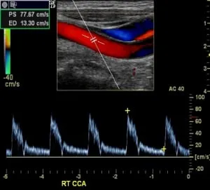 Basics of Extracranial Carotid Artery Duplex Ultrasound | IAME