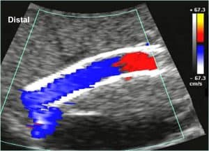 Sonography of TIPS | IAME