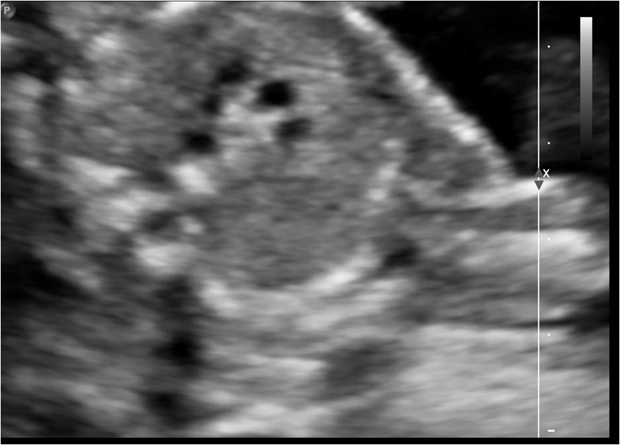 Courses | Hypoplastic Right Heart | Institute for Advanced Medical ...