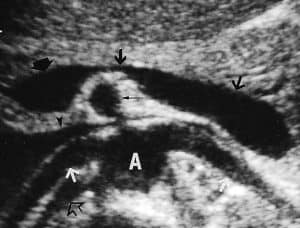Sonographic Evaluation of the Hepatoportal System | IAME