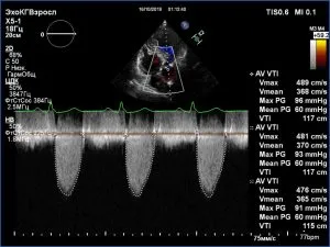 Case Studies in Rheumatic Heart Disease, Part 1 | IAME