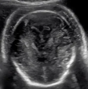 Case Studies: Fetal Hydrops